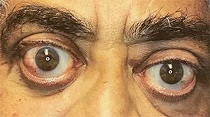 Clinical Trials for TED in San Diego | Kimberly Cockerham, MD